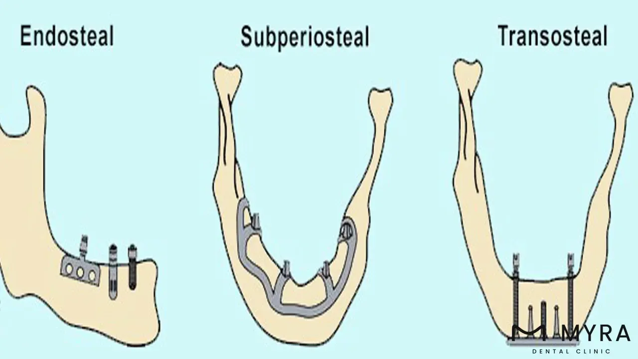 9 Different Types of Dental Implants