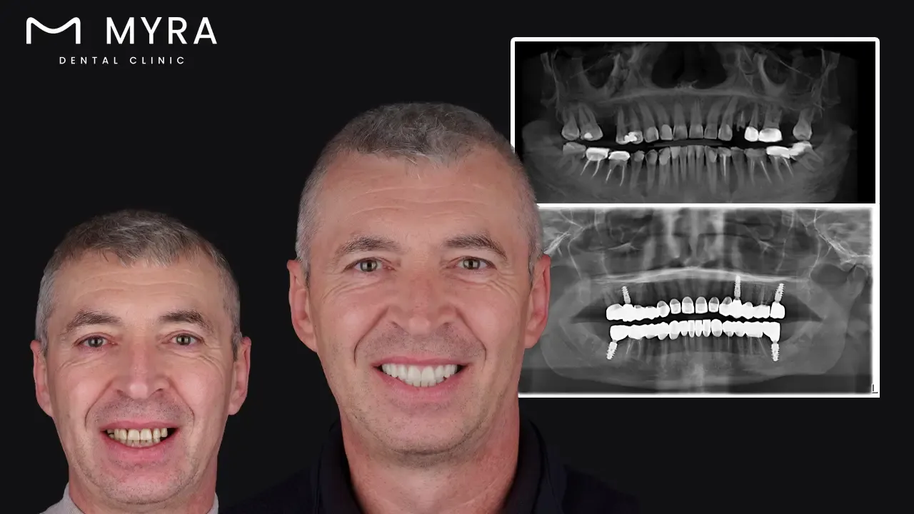 13 Essential Facts to Know Before Getting Dental Implants Abroad