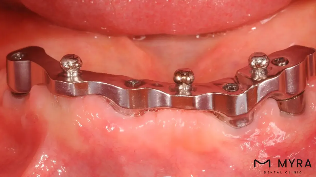 Dental Implant Overdentures: Definition, Types, Benefits, and Cost