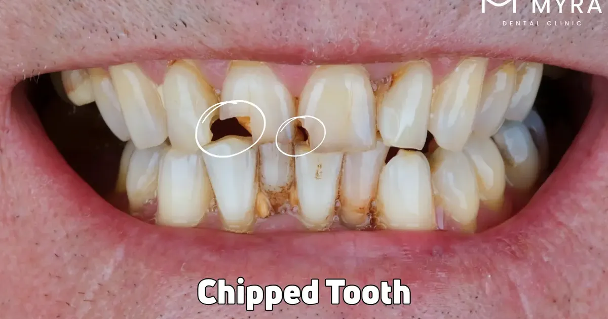Chipped Tooth: Causes, Symptoms, Risk Factors, and Treatments