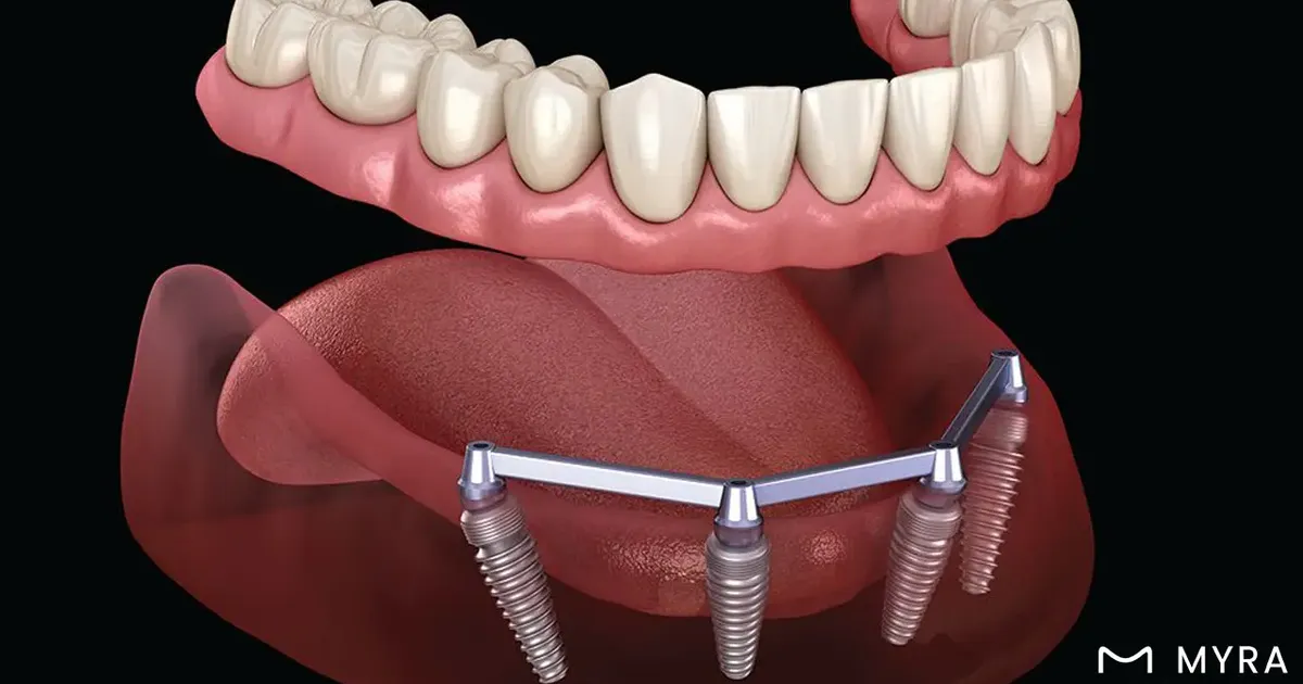 Dental Implant Overdentures: Definition, Types, Benefits, and Cost