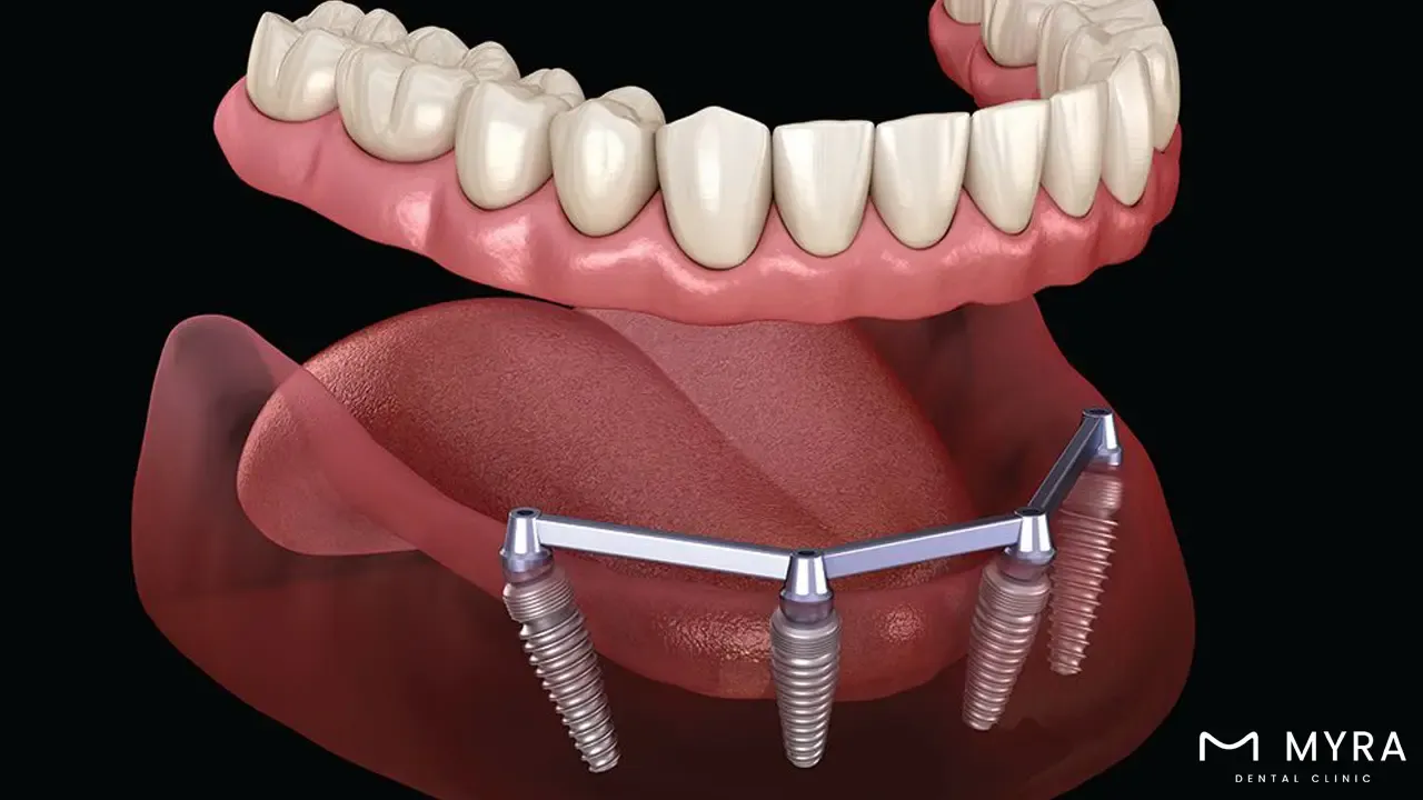 Dental Implant Overdentures: Definition, Types, Benefits, and Cost