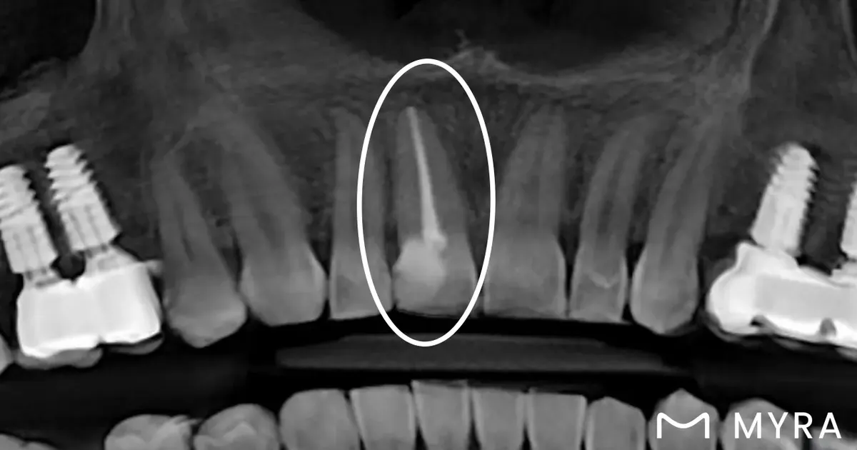 Dental Root Canal: Definition, Necessity, Procedure And Treatment
