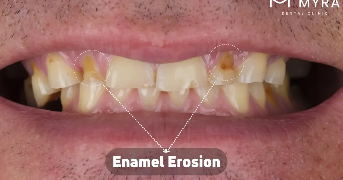 Enamel Erosion: Symptoms, Treatment, Causes