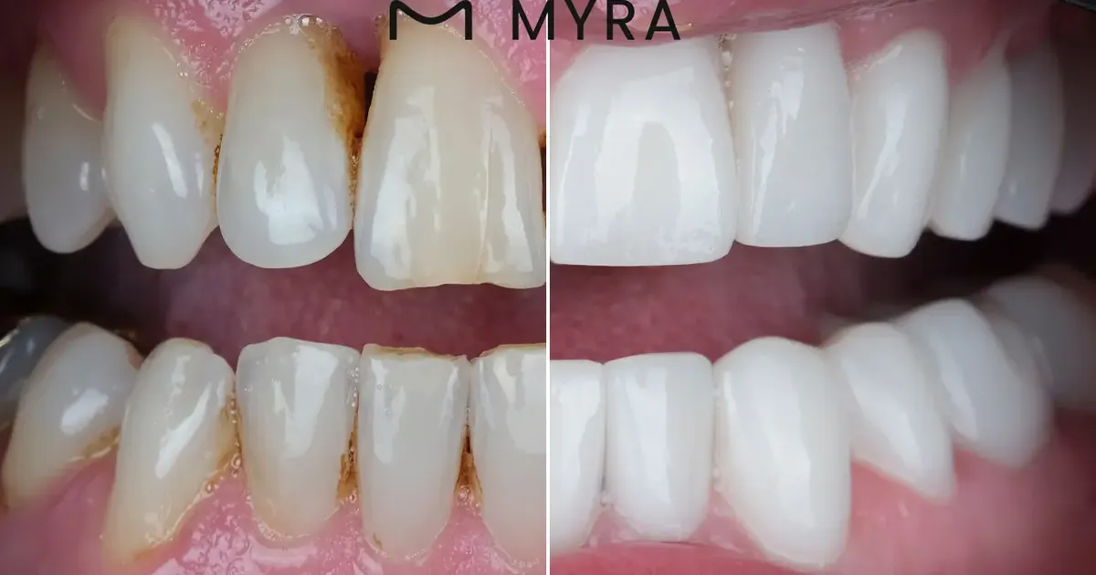 Enamel Shaping: Definition, Advantage, and Cost