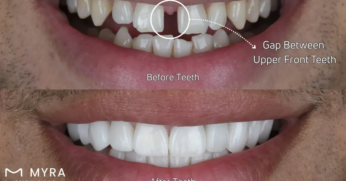 Gap Between Teeth: Symptoms, Treatment, Causes