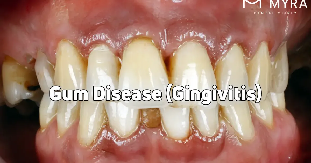 Gingivitis: Definition, Types, Cost and Recovery Duration