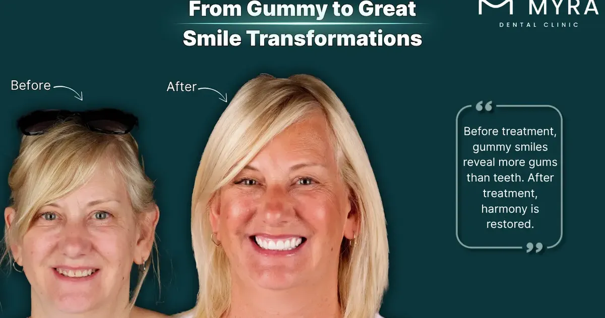 Gummy Smile: Definition, Types, Benefits, and Cost
