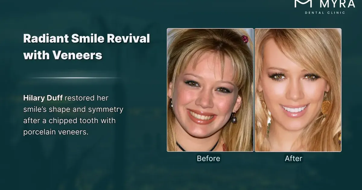 35 Celebrities With Veneers Before and After