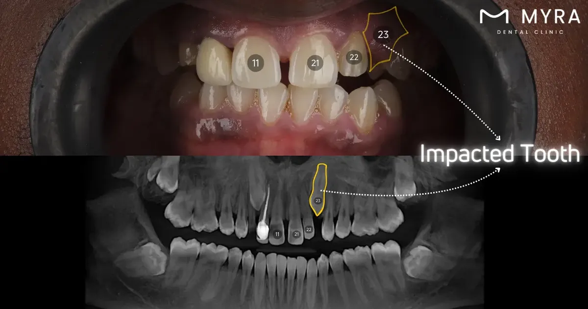 Impacted Teeth: Symptoms, Treatment, Causes