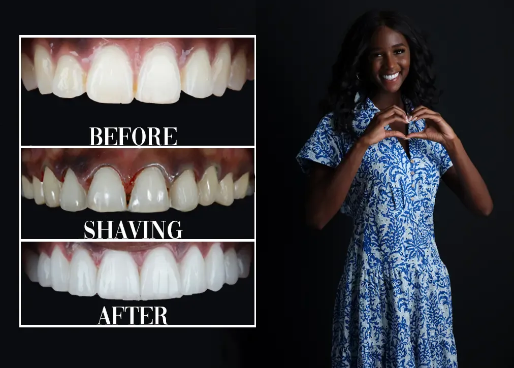 laminate veneers procedure