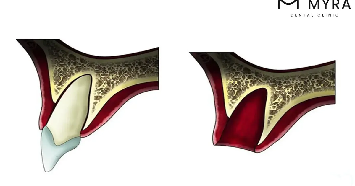 Maxillary Central Incisors: Definition, Anatomy, and Common Procedures