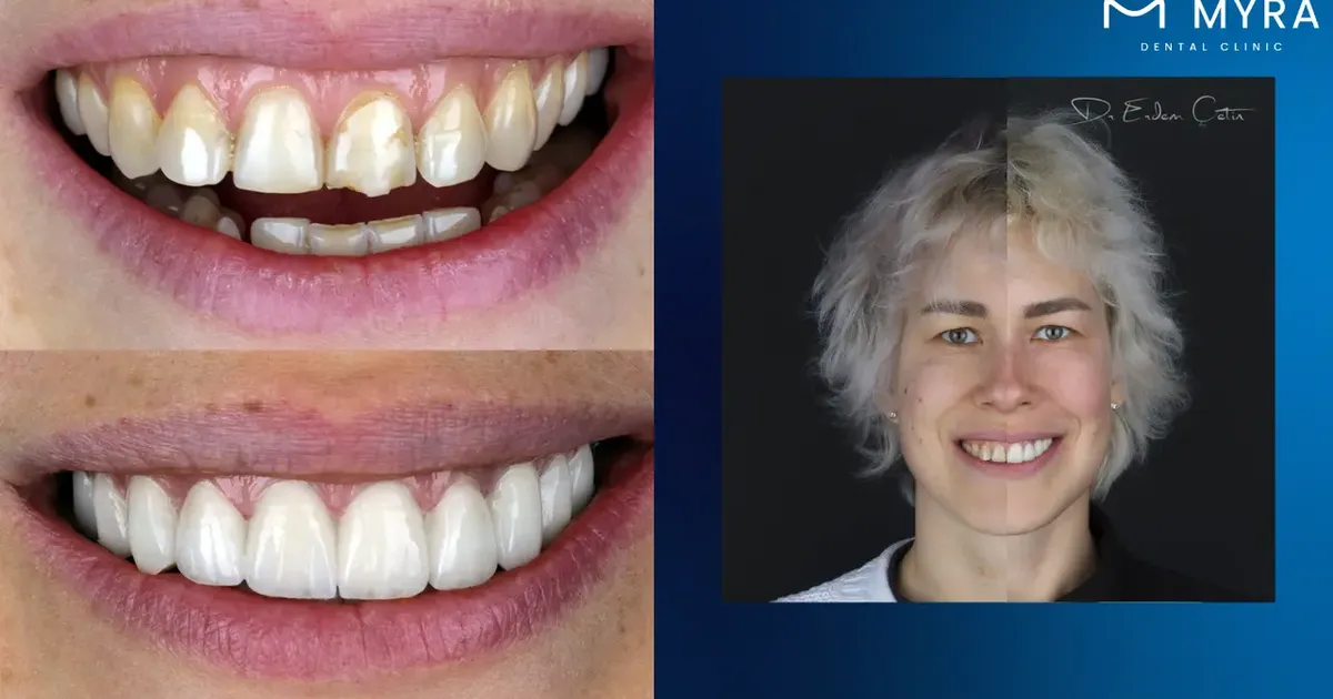 Stained Teeth Symptoms Treatment Causes