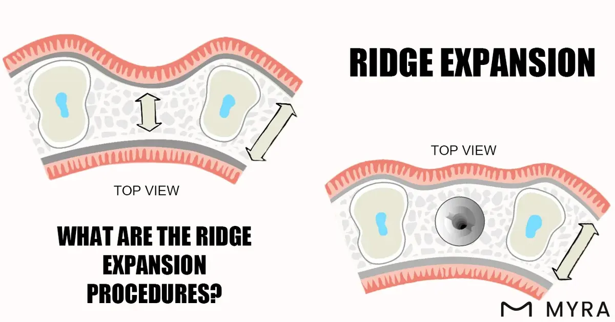Ridge Expansion: Definition, Recovery Duration, and Advantages ...
