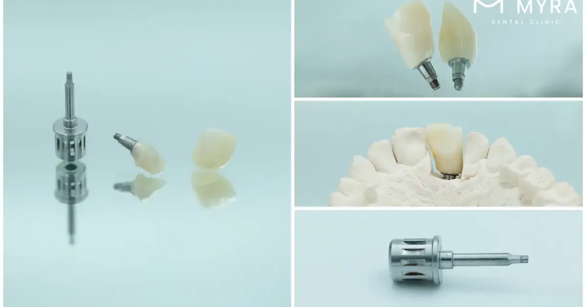 Single Tooth Dental Implant: Definition, Benefits, Procedure, and ...