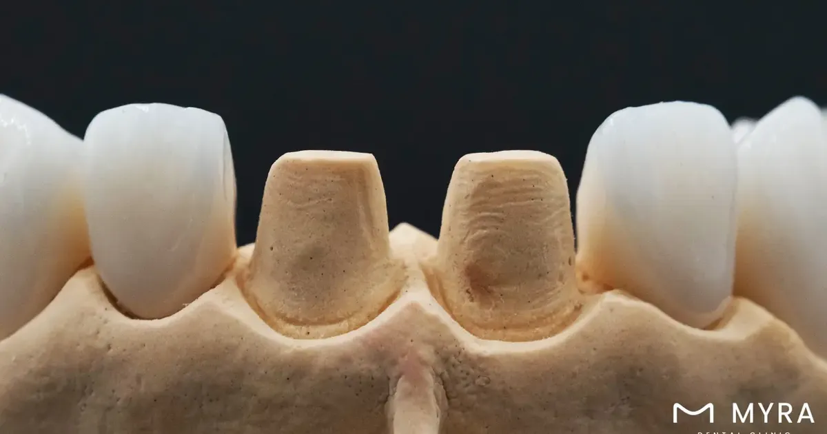 Dental Crown Definition Importance Types Procedure and Advantages ...