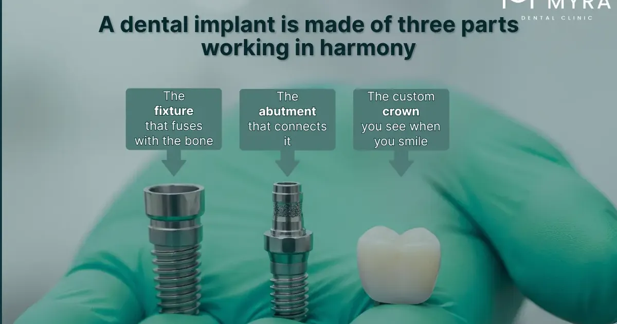 Dental Implant: Definition, Types, Cost, and Recovery Duration