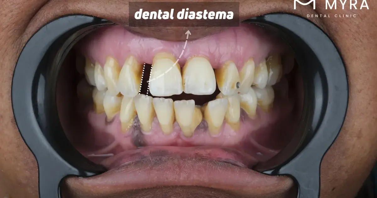 Diastema: Definition, Types,Causes, and Treatment