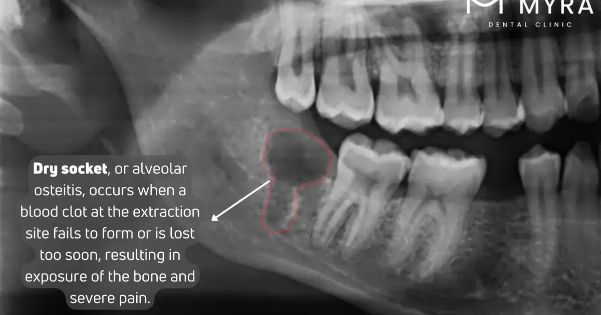 Dry Socket: Symptoms, Treatment, Causes