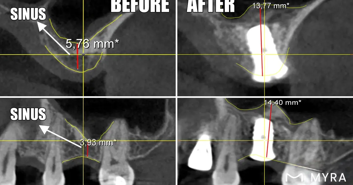 Sinus Lift: Definition, Procedures, Cost and Recovery Duration